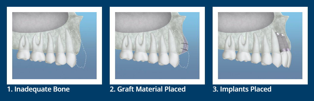 Bone Grafting for Dental Implants | Westport Periodontics